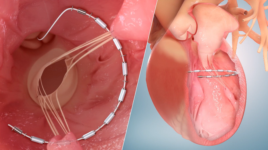 Ancora Heart Reaches Key Enrollment Milestone in Pivotal Heart Failure ...