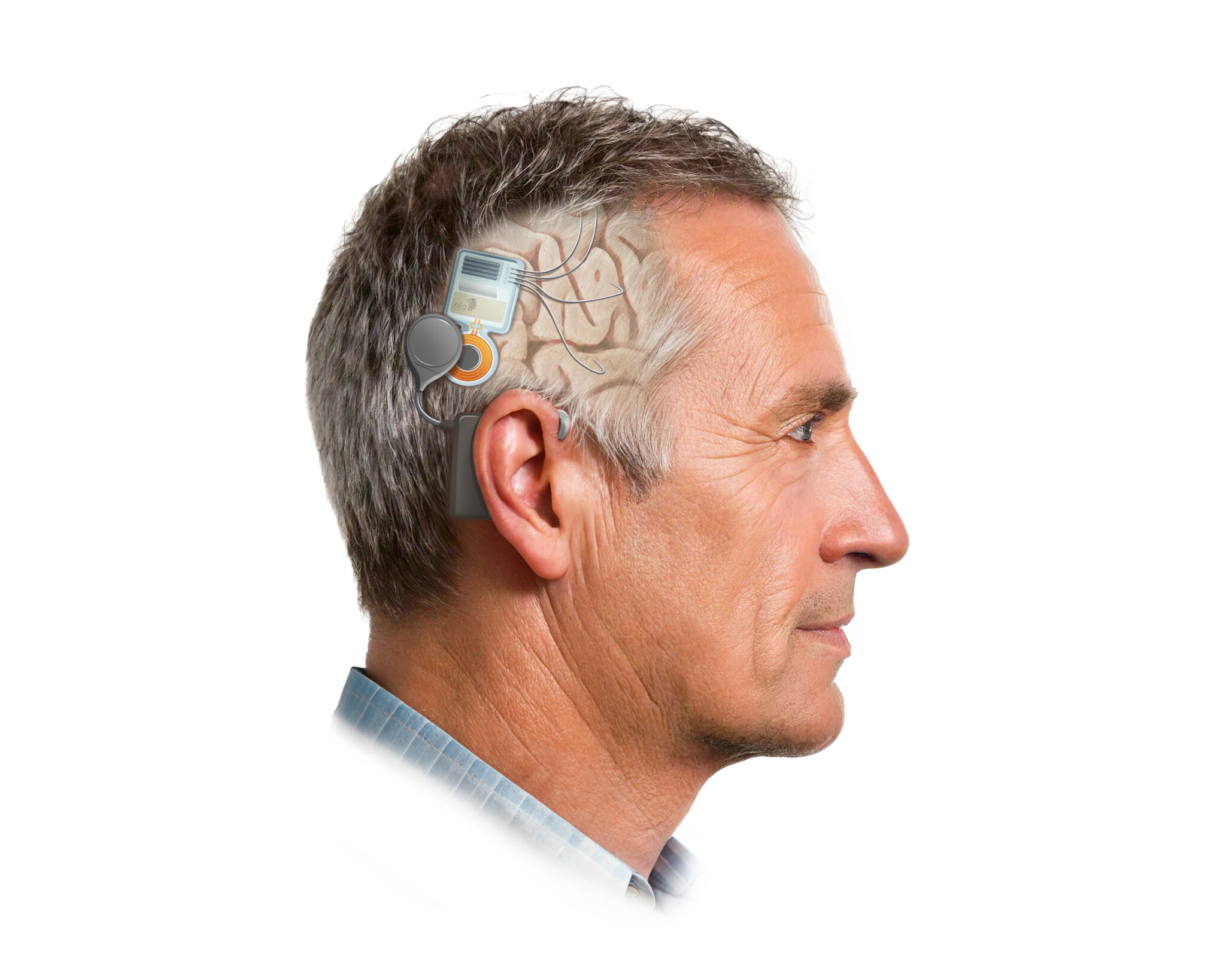 Nia Therapeutics Validates 60-Channel Brain Implant for Closed-Loop ...